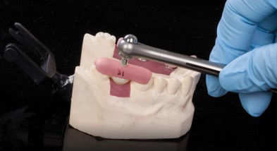 Seating crowns on implant abutments | Blue Crane Dental Lab
