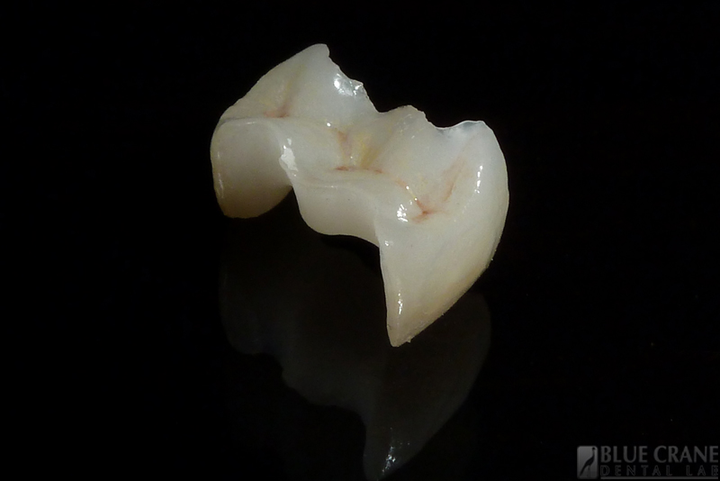 IPS e.max | Blue Crane Dental Lab