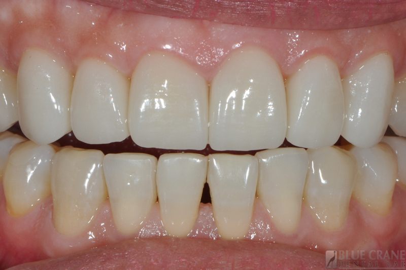 IPS e.max | Blue Crane Dental Lab