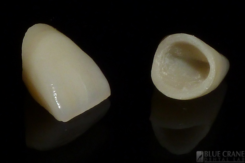 IPS e.max | Blue Crane Dental Lab